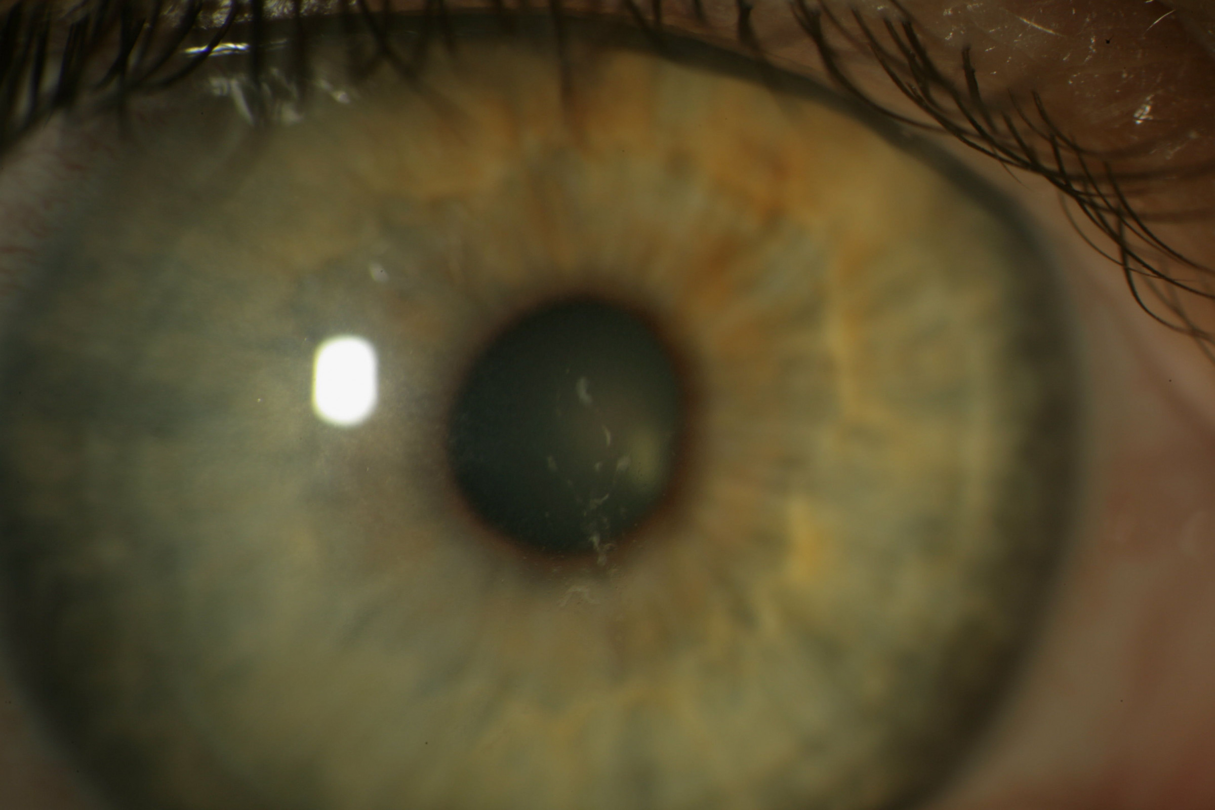 Herpes Zoster Pseudodendrito Oftalmico