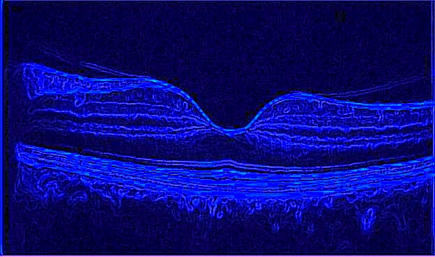 blue retina – Ophthalmology and Visual Sciences – UW–Madison